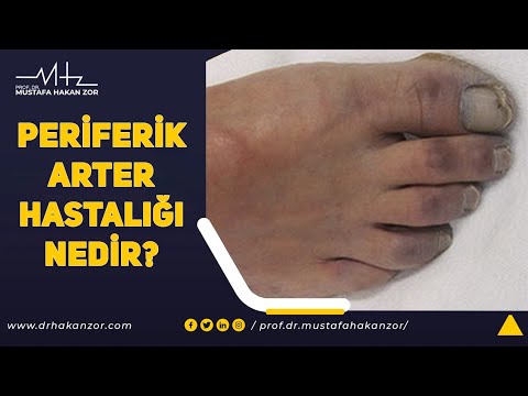 What is Peripheral Arterial Disease? What are the Symptoms of Peripheral Artery Disease?