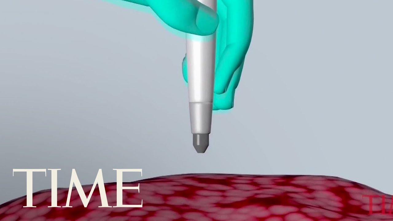 This Pen Can Diagnose Cancer In 10 Seconds: New Technology Discovered At University Of Texas | TIME