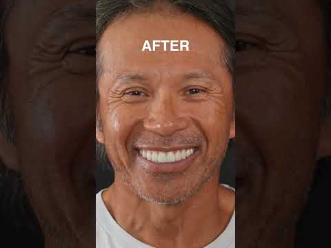 BEFORE AND AFTER DENTAL IMPLANT TRANSFORMATION!