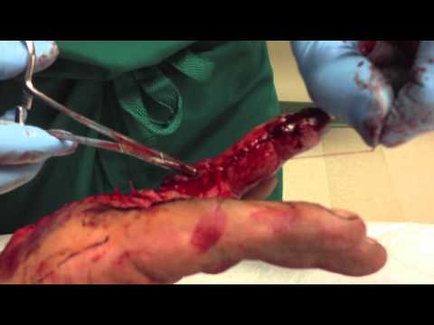 Complex Hand Lac - part 5