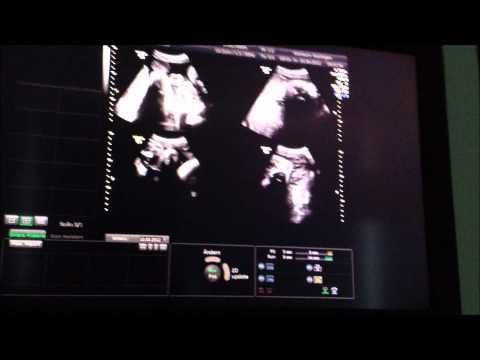 Ultraschall-Untersuchung, SSW 37 im Klinikum Esslingen | Janas ...