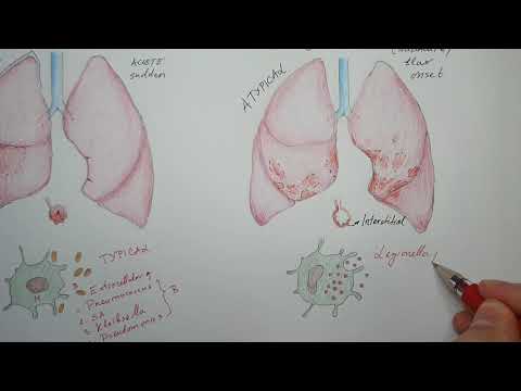 Typical VS Atypical pneumonia