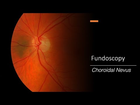 Choroidal Nevus: Fundoscopy