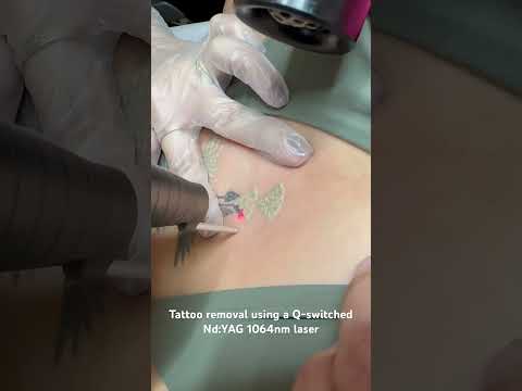 Tattoo removal with a Q-switched Nd:YAG 1064nm laser #tattooremovallaser #tattooremoval