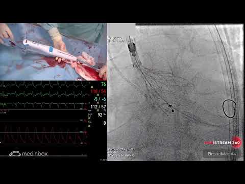 TAVI Using 29 mm Navitor Self Expanding Valve