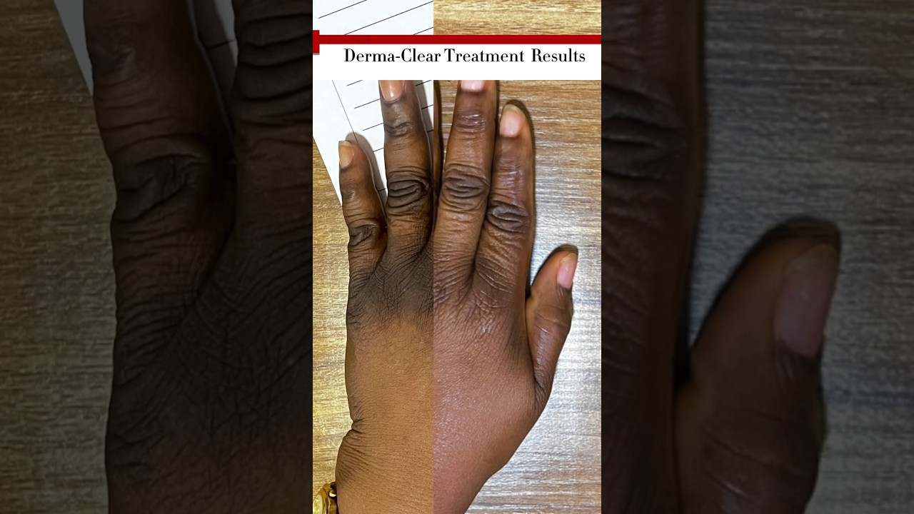 Skin lichenification: Treatment of Dark knuckles  at Bregha Beauty Clinic #aestheticclinic