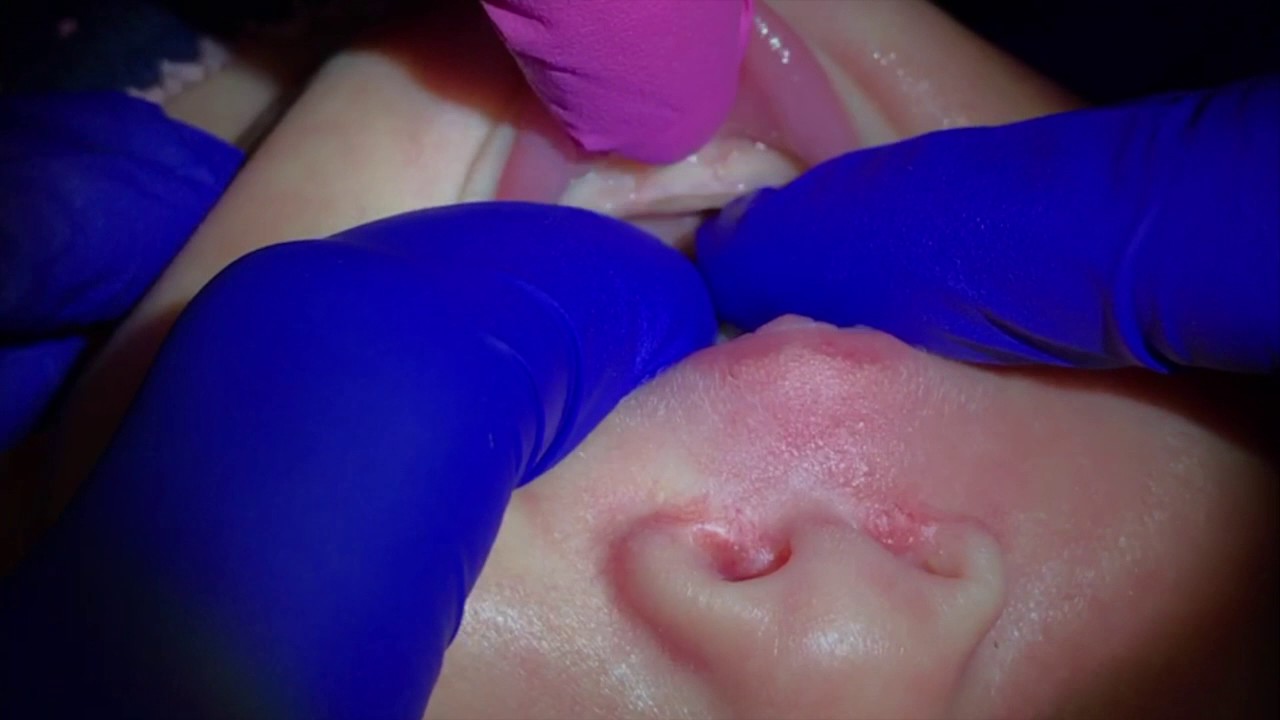How To Examine a Baby for Tongue-Tie and Lip-Tie