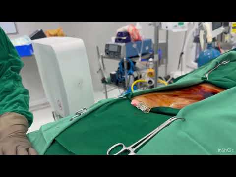 Spine injection- Caudal plus nerve root block for slip disc problem
