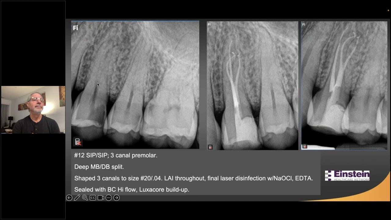 Technology Enhancement with Laser Assisted Endodontics 1