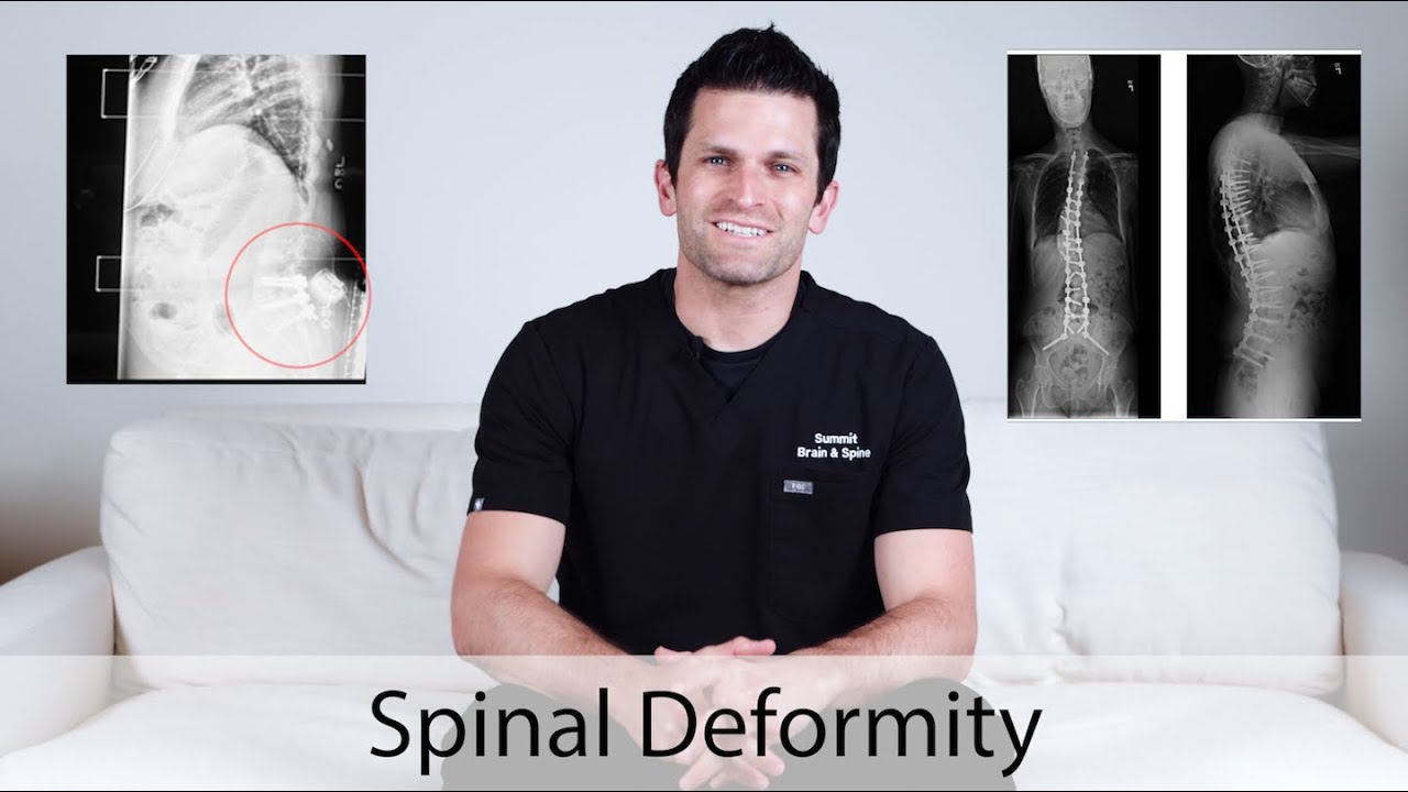 Spinal Deformities