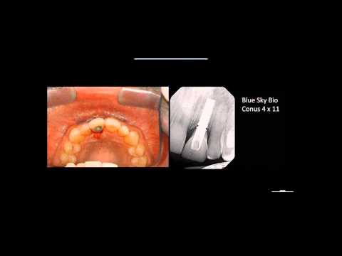Course: The 3D Click Guide; safe simple and affordable model based guided implant placement. 5