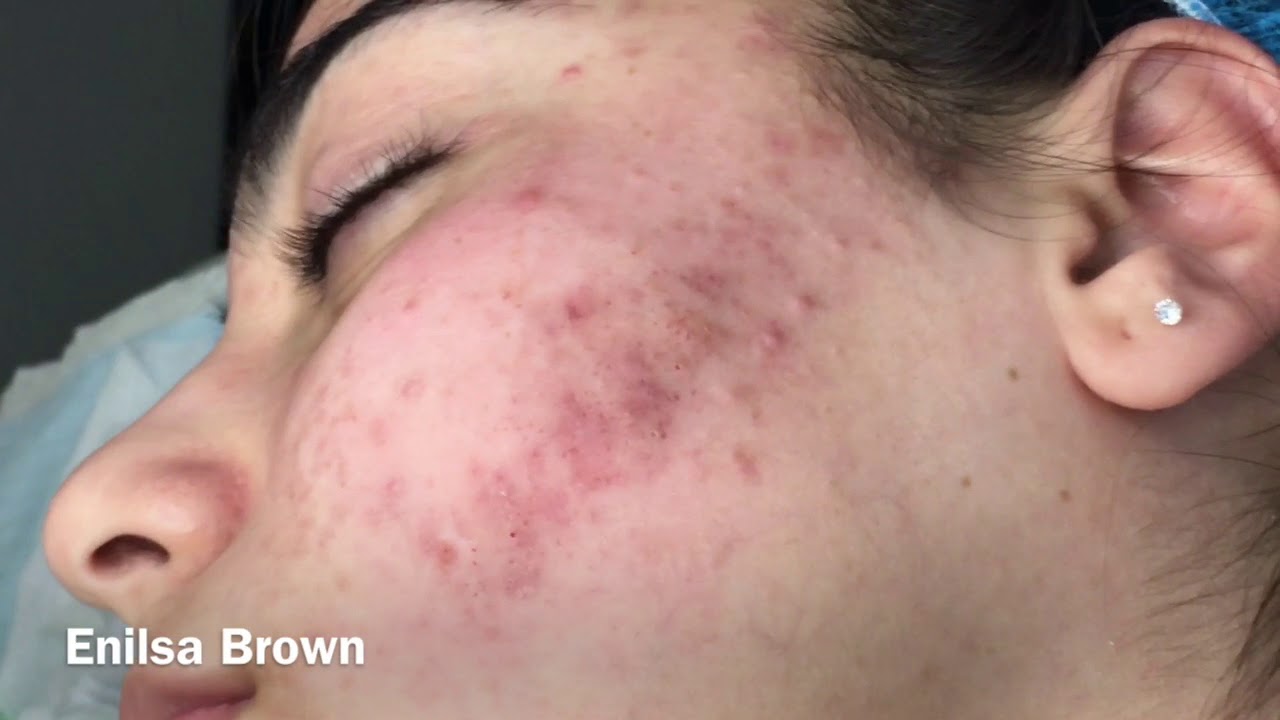 Emily Extractions Part 2