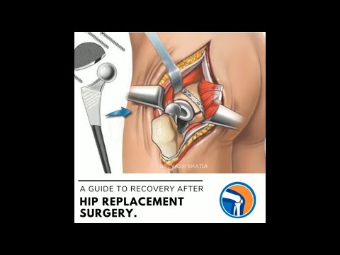 Hip Replacement Surgeon || Dr Yash Bhatia Orthopaedics Centre | New Rajender Place