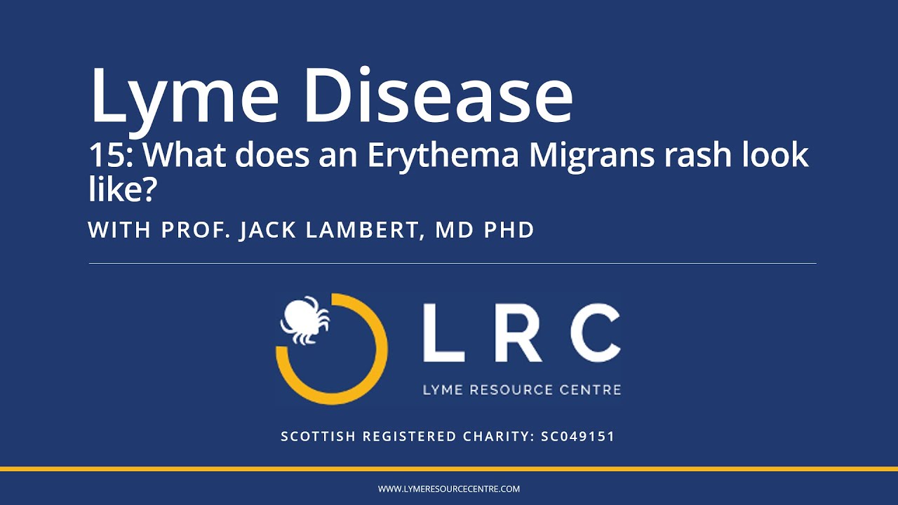 Lyme Disease - Small Bites for GPs 15: What does an Erythema Migrans rash look like?