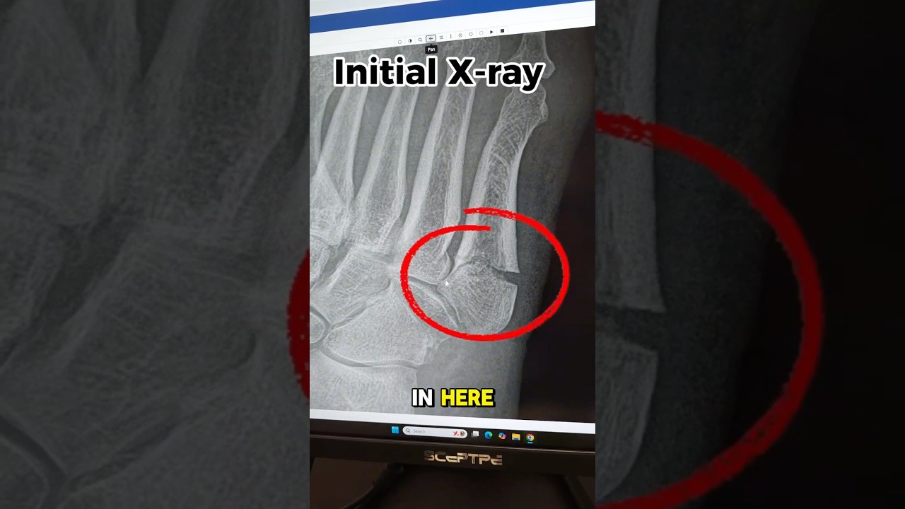 Learn how a few millimeters can impact a fracture’s recovery. Today’s video on a #jonesfracture