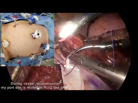 Port placement of Lap-Pancreaticoduodenectomy portal vein resection(cadevaric vein interpostion)