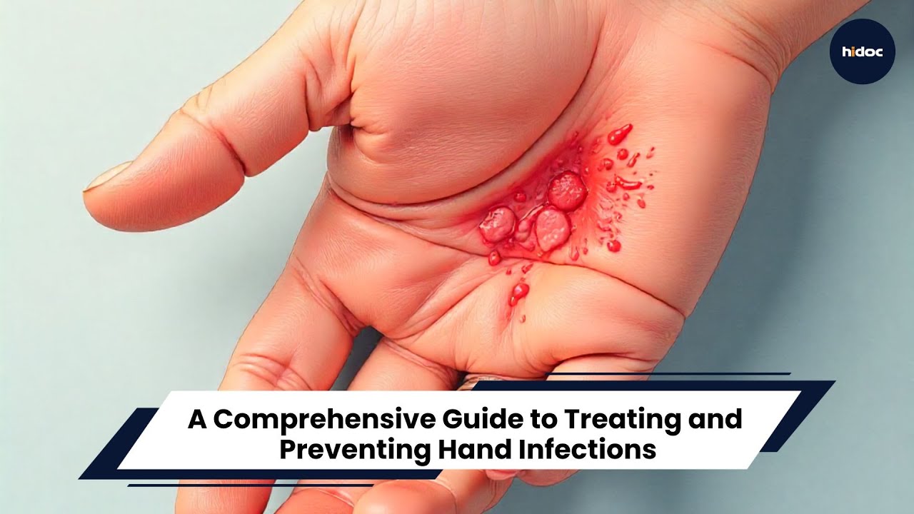 A Comprehensive Guide to Treating and Preventing Hand Infections.