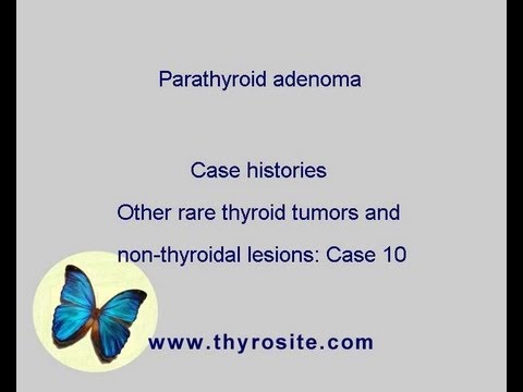 Parathyroid adenoma. Other rare tumors in the region of the thyroid - case 10