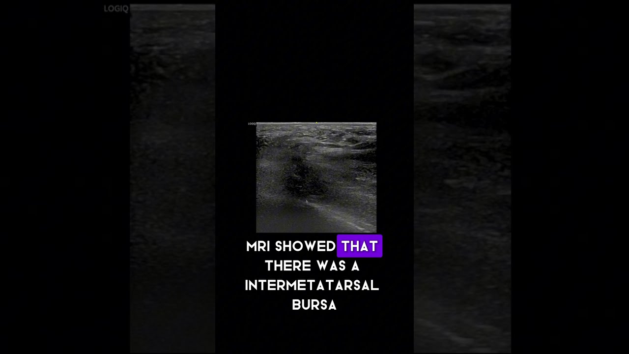 #ultrasound Guided Interventions: Cases (Inter-metatarsal Bursa)