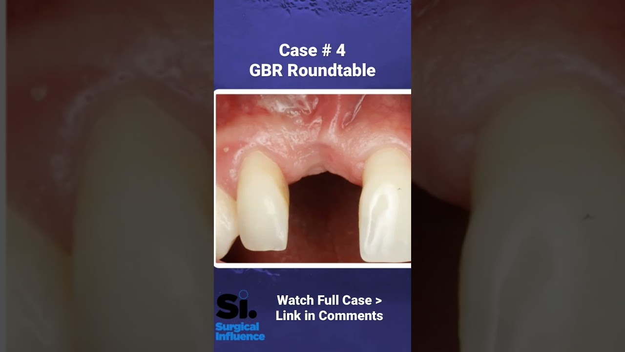 Guided Bone Regeneration | Soft Tissue Case 4 #dentaleducation #softtissue #stickybone