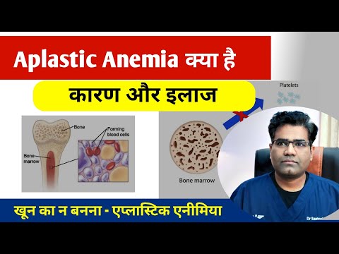 Aplastic Anemia Causes and Treatment Explained | एप्लास्टिक एनीमिया (खून का न बनना)