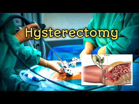 Hysterectomy recovery tamil| கர்ப்பப்பை நீக்கிய பின் பயிற்சிகள்| Full Explanation| #short #shorts