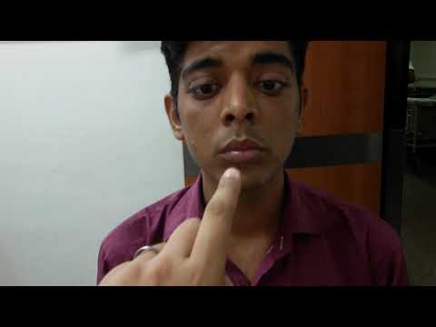 Thyroid opthalmopathy :Graves disease-Negative Lid lag and Mobius sign
