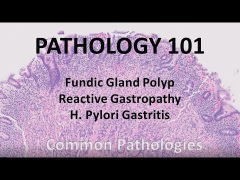 Fundic Gland Polyp, Reactive Gastropathy, and H. Pylori gastritis | Pathology 101| GI Pathology