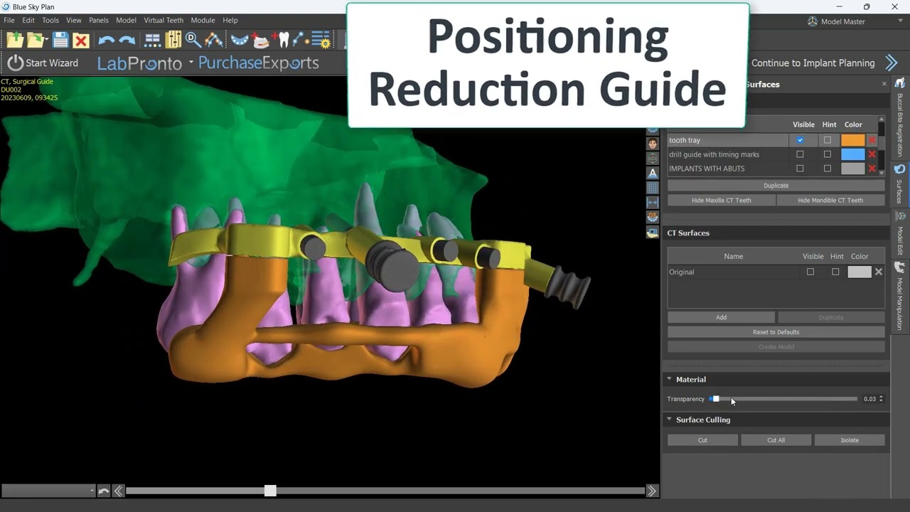Stackable Guide Workflow in Blue Sky Plan (Timelapse)