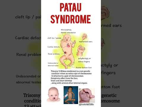 Patau syndrome | Trisomy 13 | #patausyndrome #trisomy13 #viralvideo