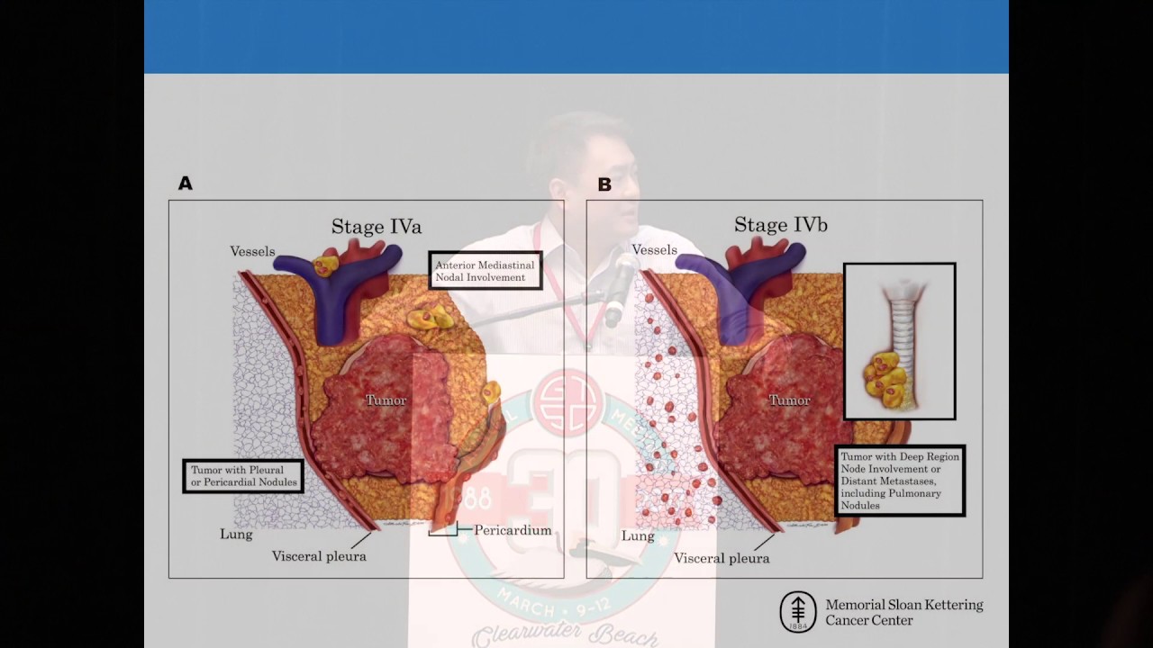 Huang   Thymoma Thymic Carcinoma