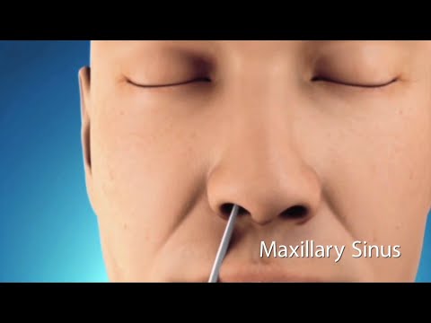 Sinus Procedure