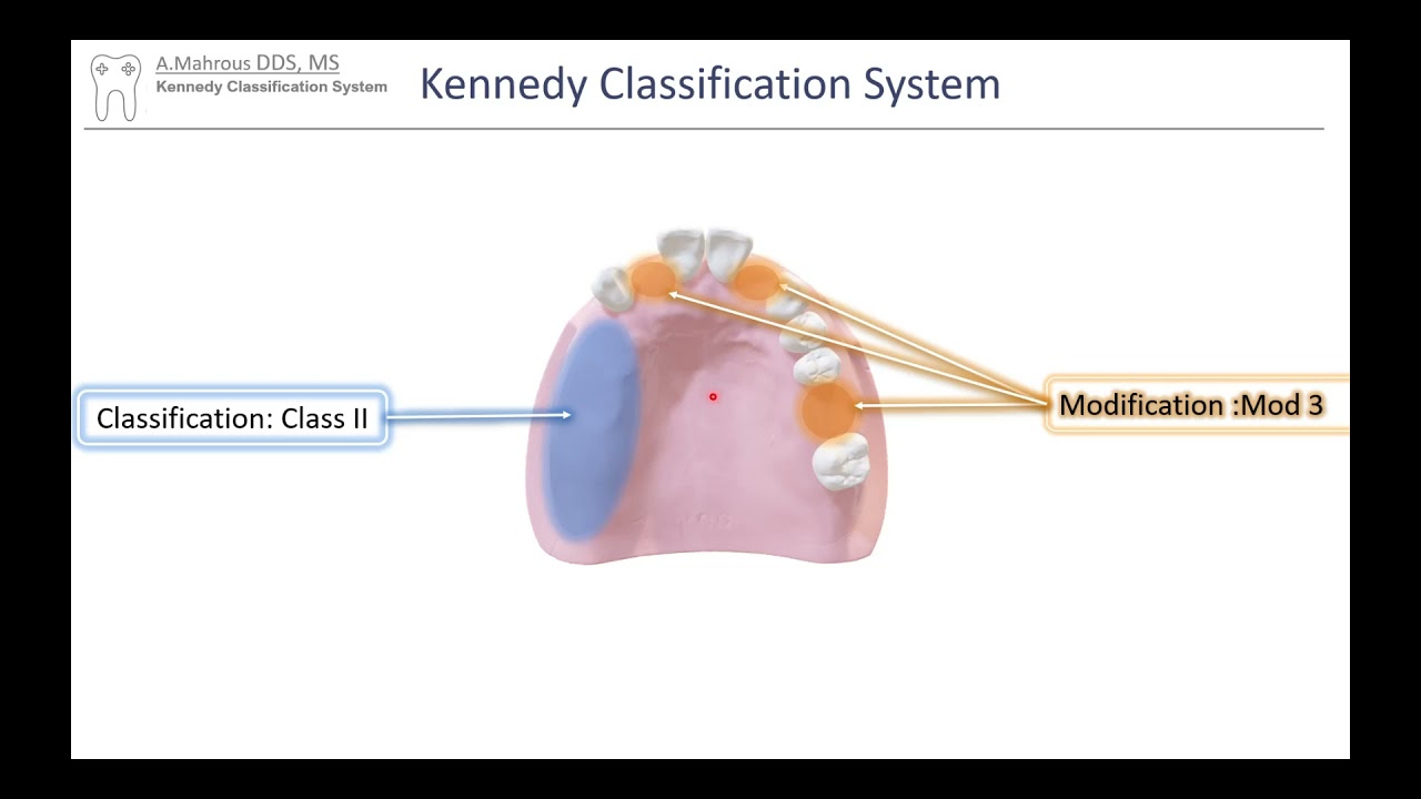 RPD Kennedy Classification : In 10 Mins- RPD ( Removable Partial Denture)  online Course