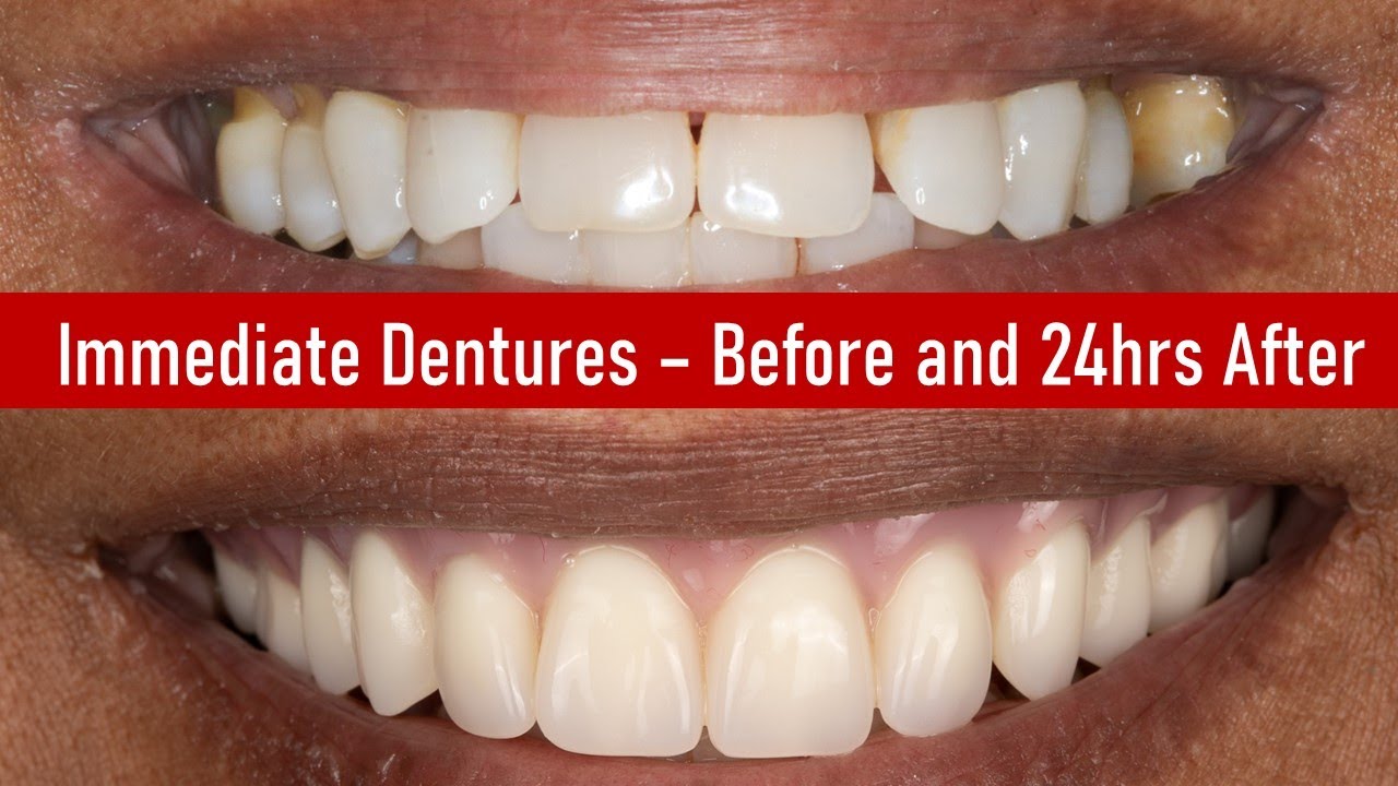 Immediate Dentures Before and 24hr After