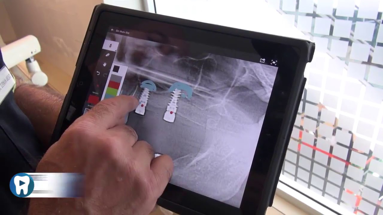 Tutorial  Bone grafting and sinus lift for dental implant bridge