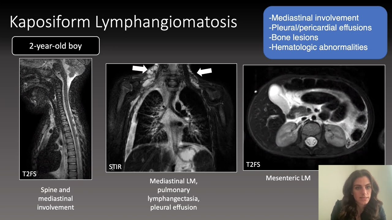 Lymphatic Anomalies in Children: Update on Imaging Diagnosis, Genetics and Treatment