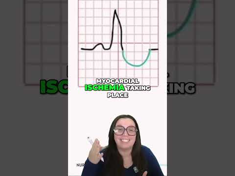 Understanding ST Depression in EKG Causes, Symptoms, and Management