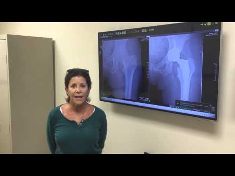 Direct Anterior total hip replacement - 8 days after surgery