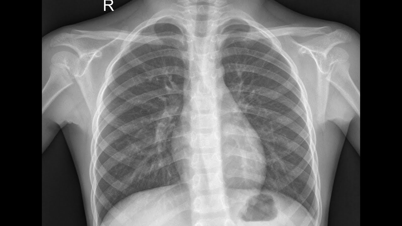 🚑 X Ray Image Classification Part2
