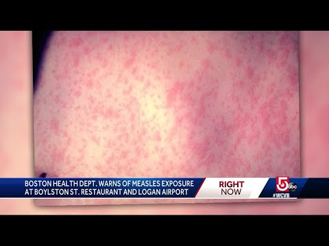 Measles alert issued for two popular Boston spots