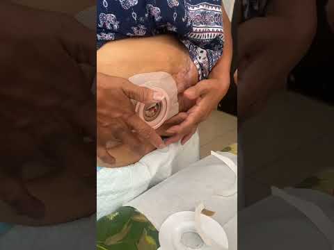 ¿Cómo cambiar tu bolsa de colostomía? #salud #medico