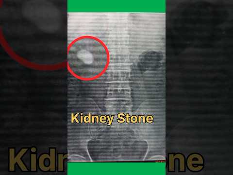 Xray KUB Kidney Stone #radiologycareer #anatomy #radiology #medicalimaging #doctor #radiological #m
