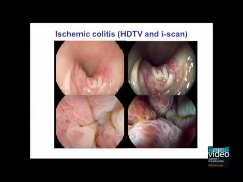 Endoscopic Spectrum of Ischemic Colitis