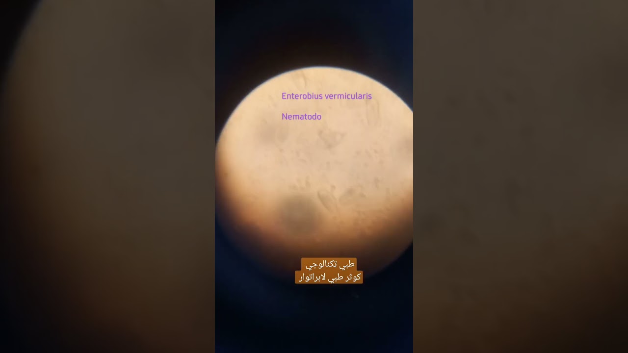 Enterobius vermicularisNematodo Eggs in Stool Exam.