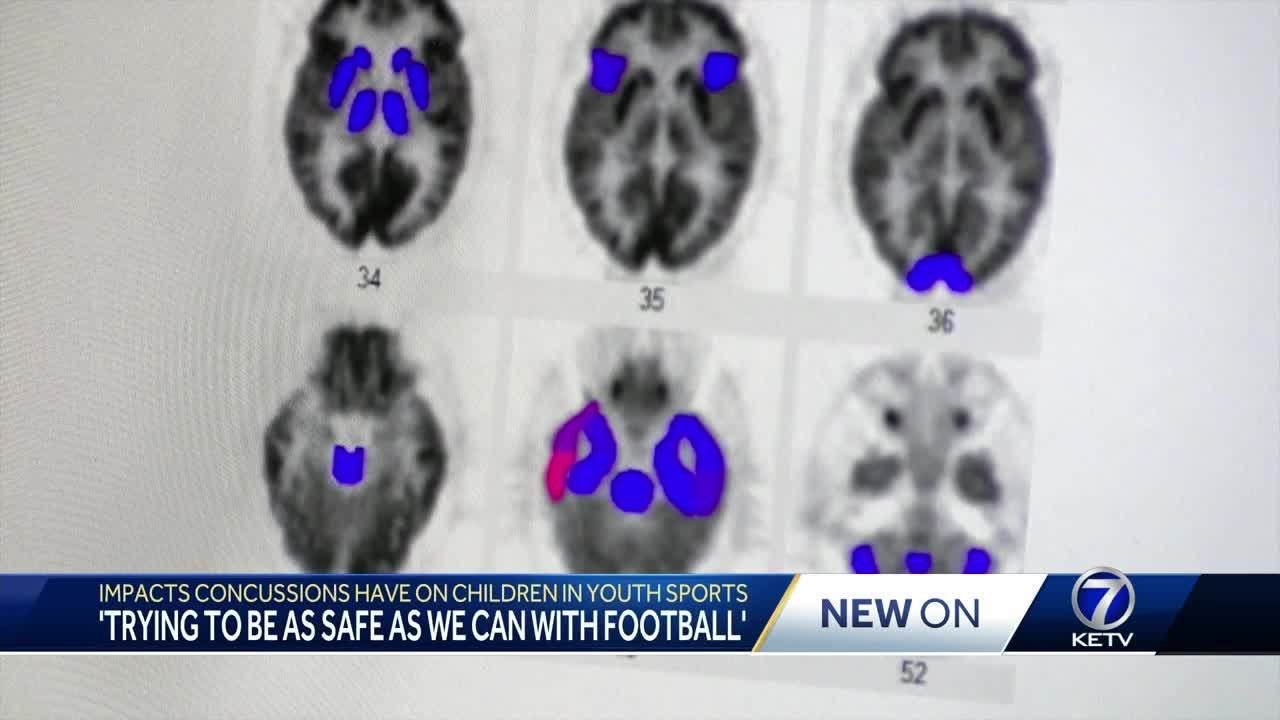Concussions in youth sports