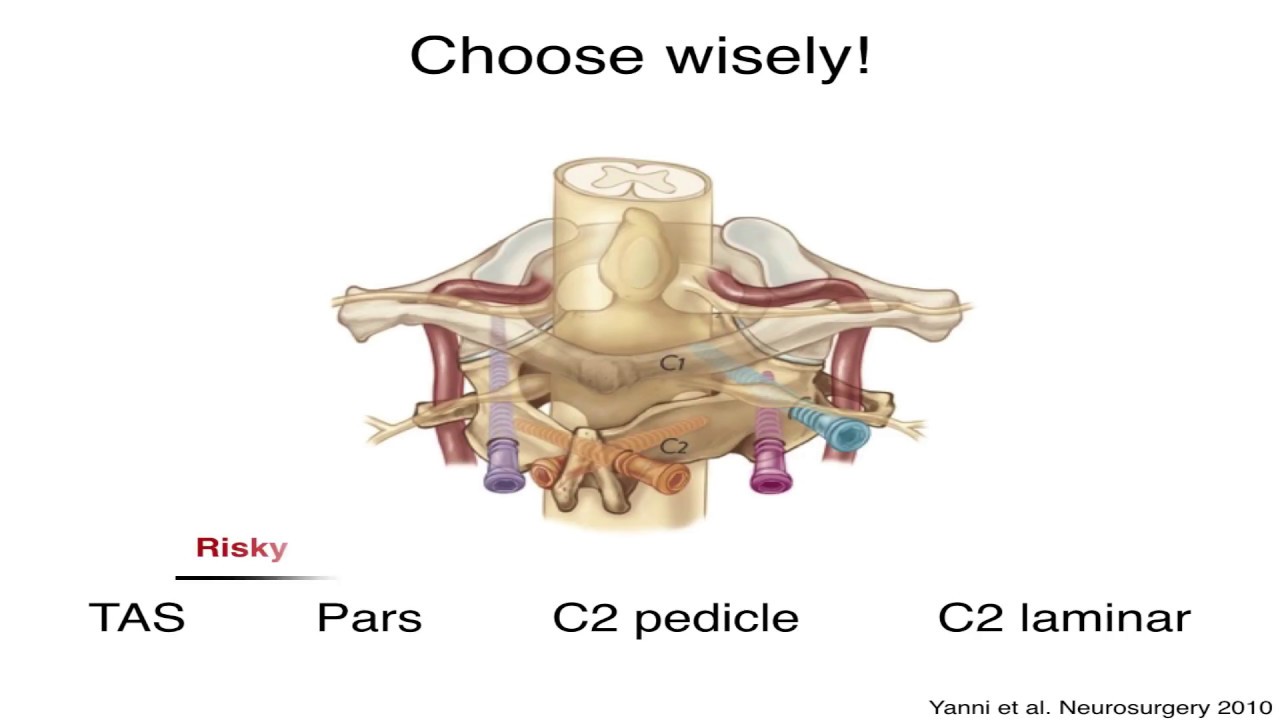 How to tackle vertebral artery injury in craniovertebral spine surgery - Dr Kshitij Chaudhary