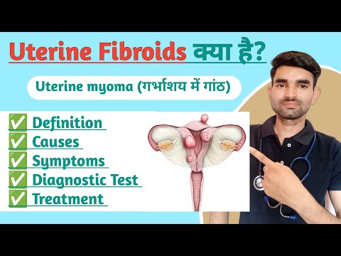 Uterine Fibroids in Hindi | Causes, Symptoms And Treatment of Uterine Fibroids