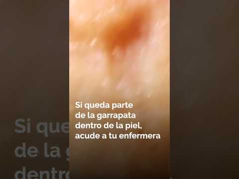 Qué hacer si te pica una garrapata