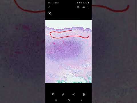 Dermatofibroma