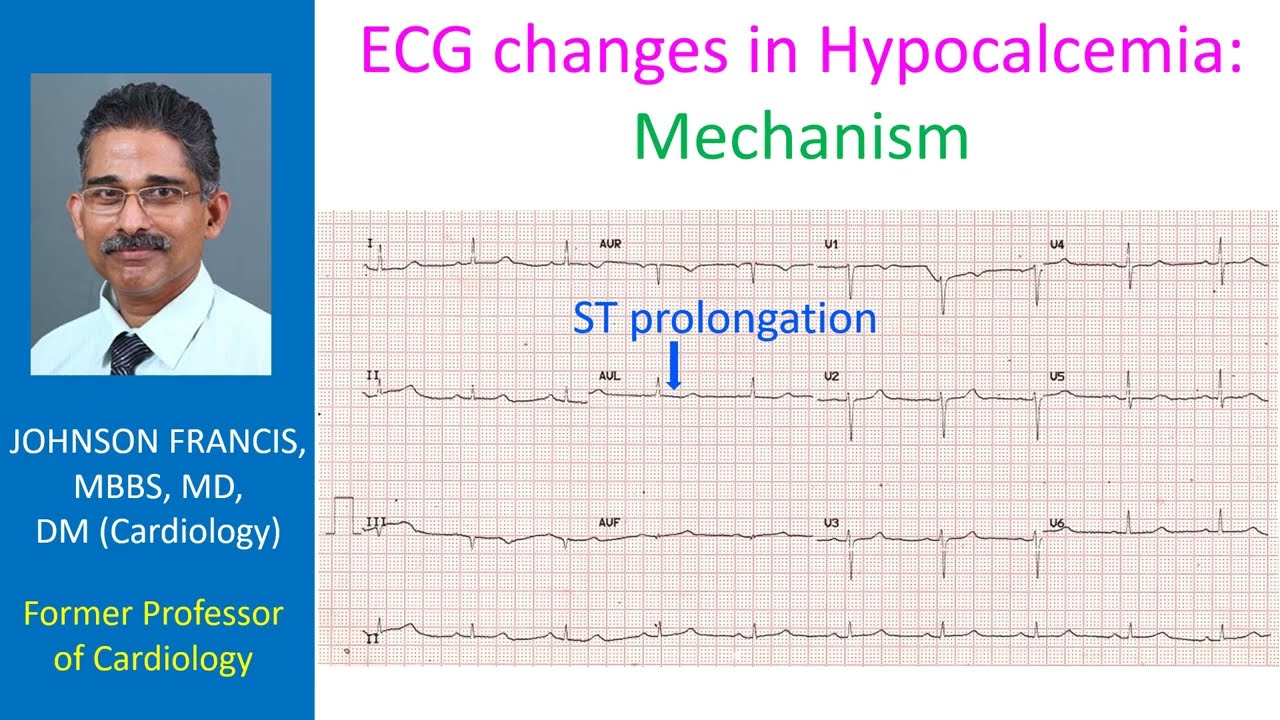 ECG changes in hypocalcemia: Mechanism